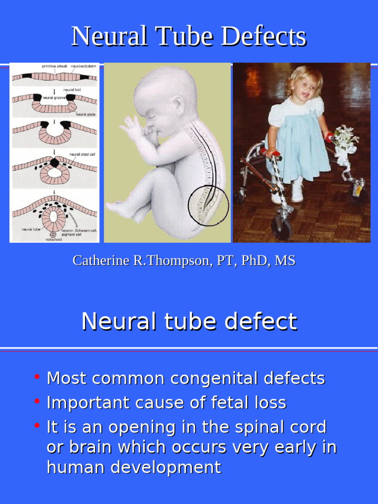 Neural Tube Defect | PDF | Diseases And Disorders | Self-Improvement