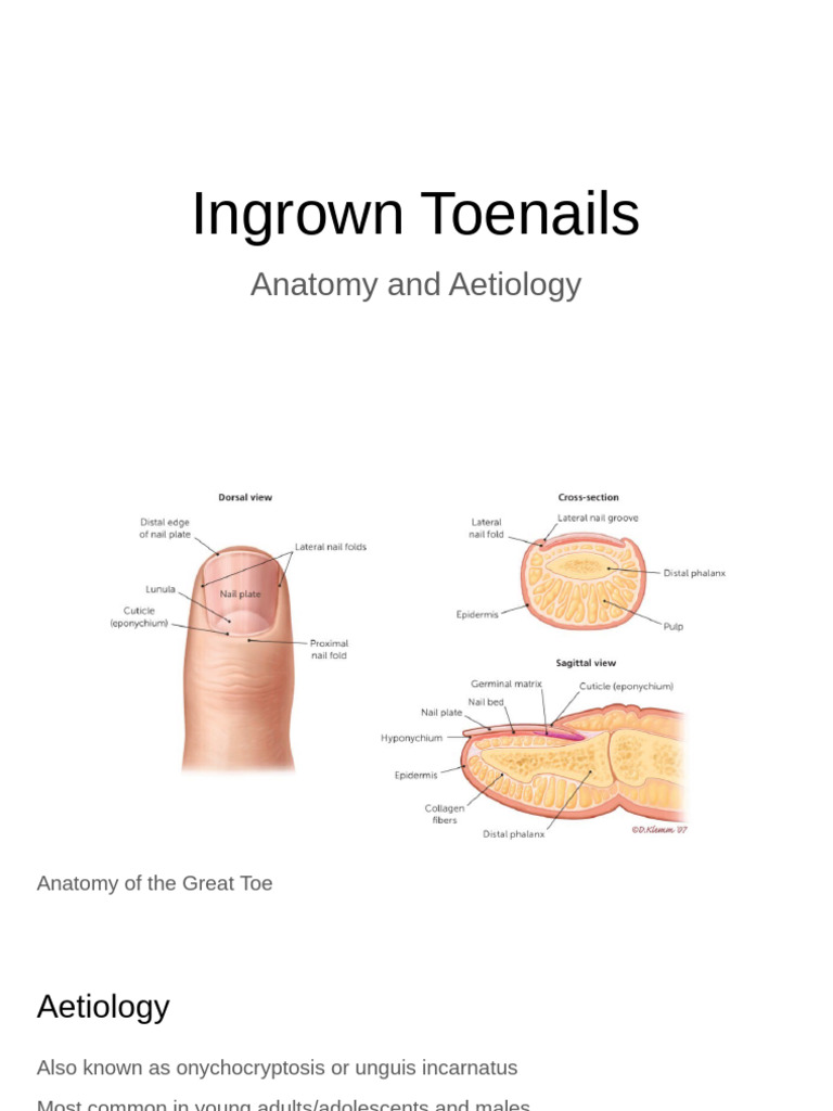 Ingrown Toenails | PDF
