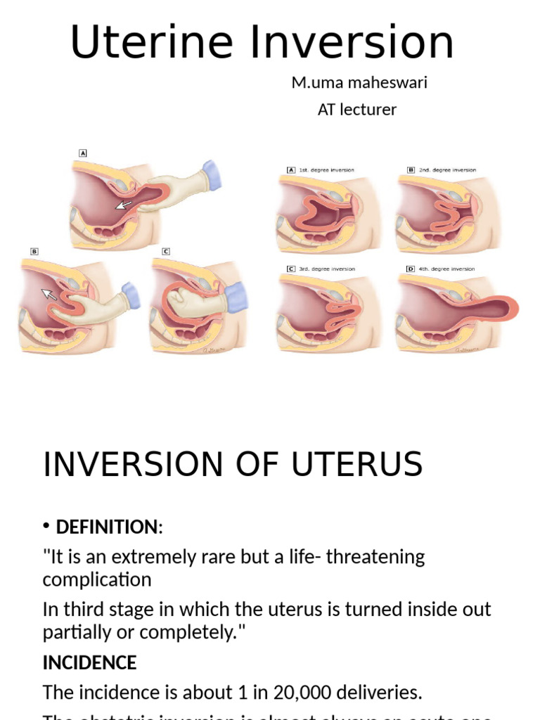 Uterine Inversion | PDF