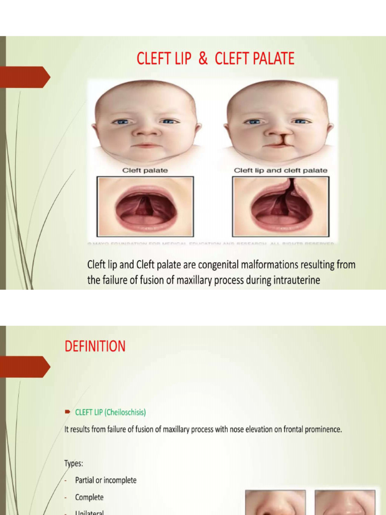 Cleft Lip and Palate | PDF