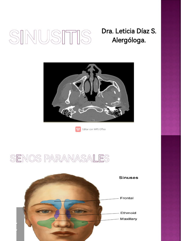 sinusitis unison | PDF