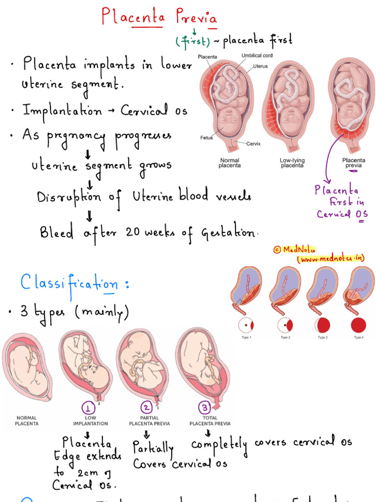Placenta Previa | PDF
