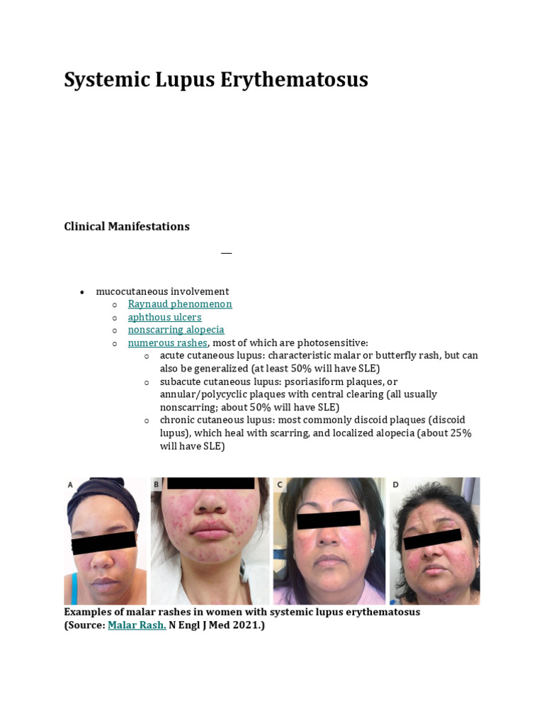 Systemic Lupus Erythematosus | PDF