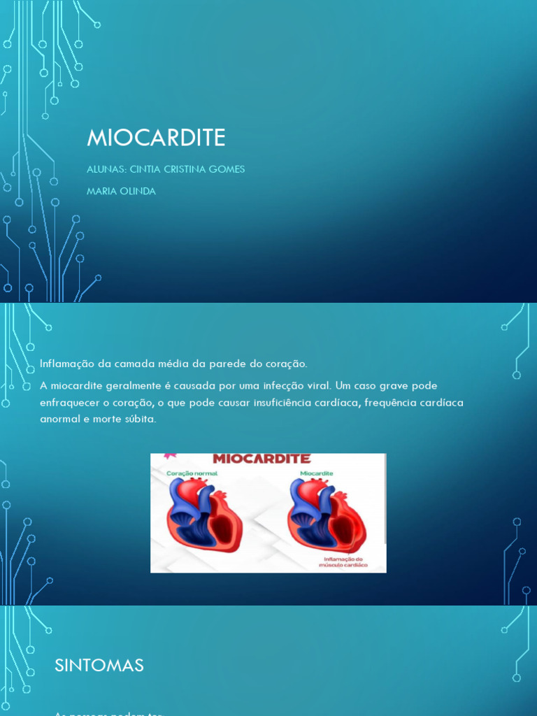 Miocardite | PDF