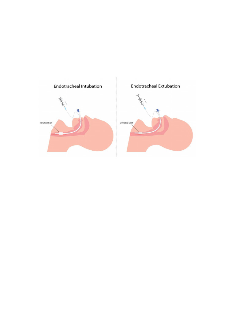 Extubation Procedure | PDF