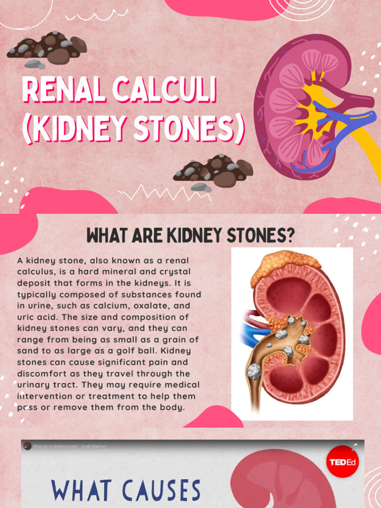 Kidney Stones Ppt | PDF
