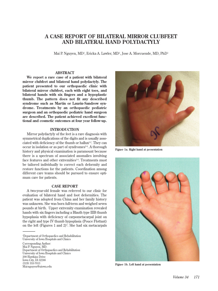 Nguyen A Case Report of Bilateral Mirror Feet and Bilateral Hand Polydactyly | PDF