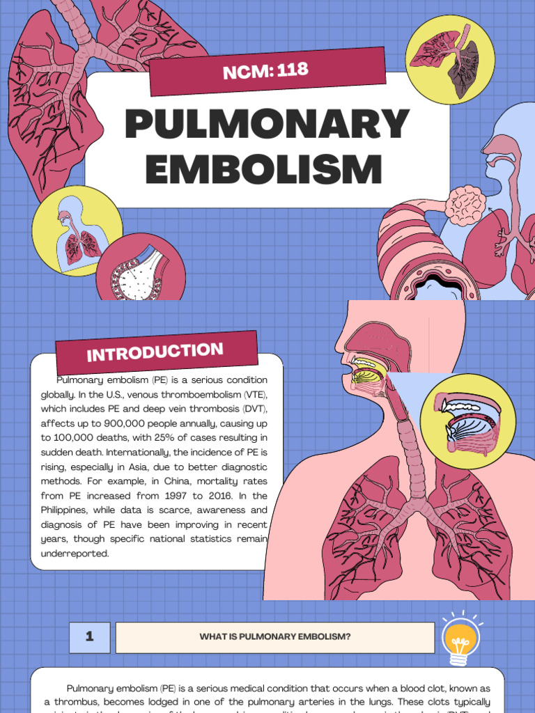 Pulmonary Embolism | PDF