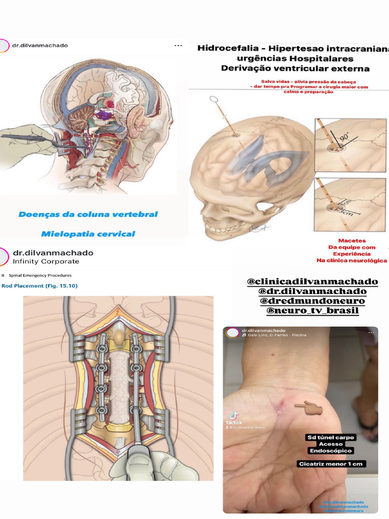 Artrodese DR DILVAN | PDF
