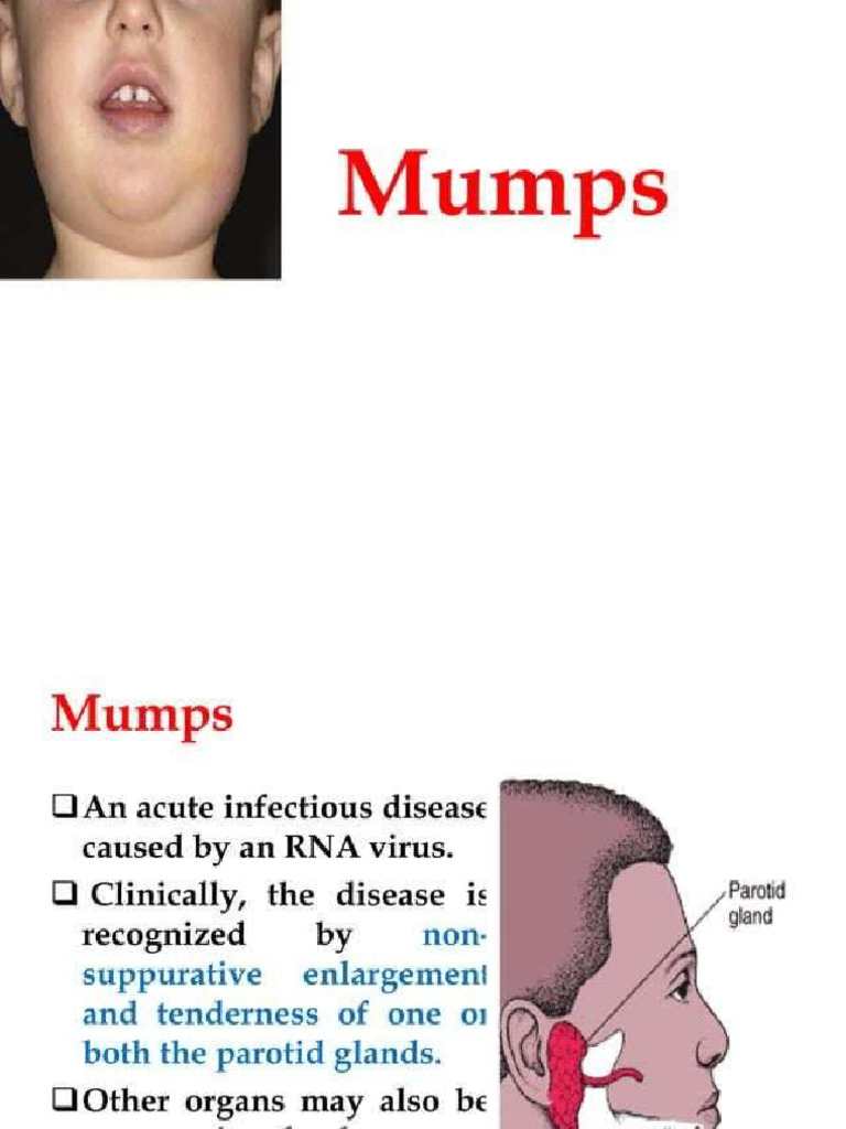 Mumps 3 | PDF