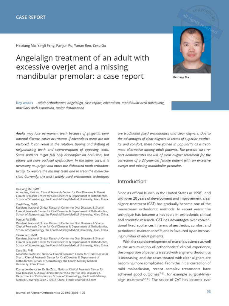 Angelalign Treatment of An Adult With Excessive Overjet and A Missing ...