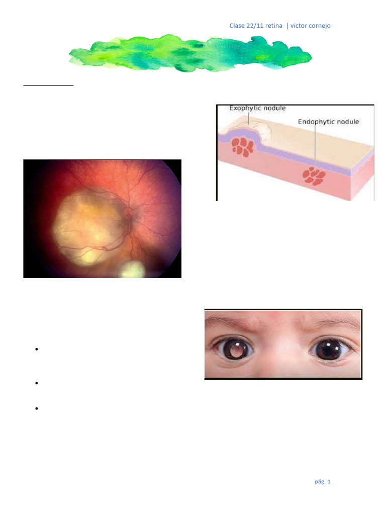 Retina Tumores | PDF