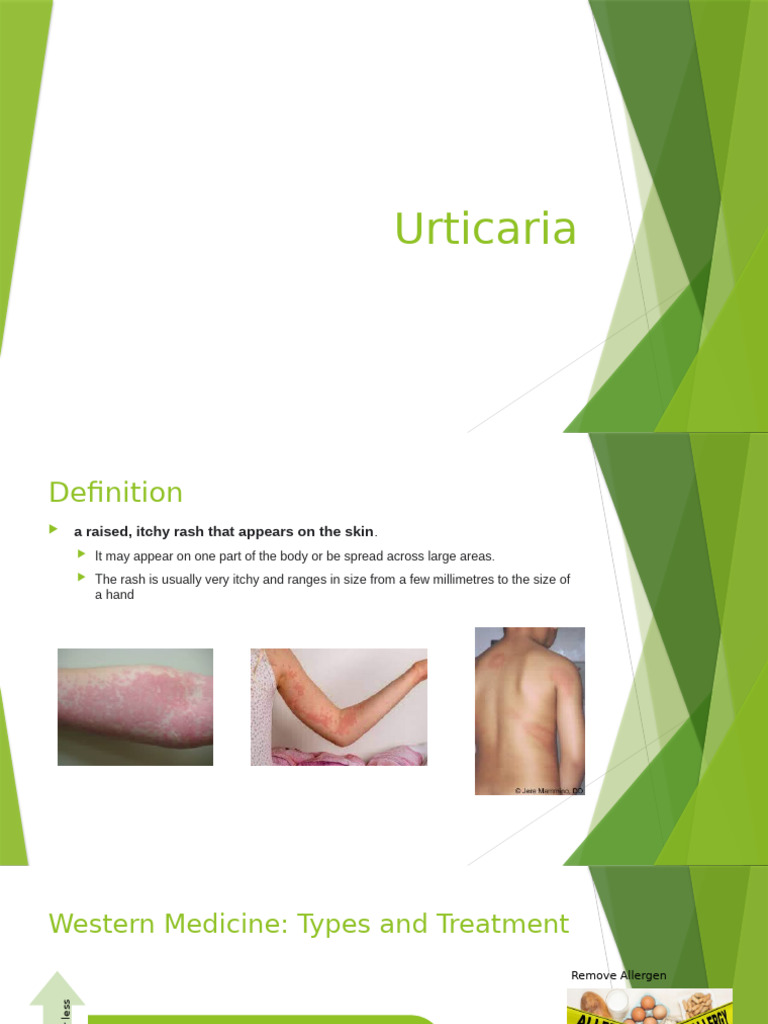 Urticaria | PDF