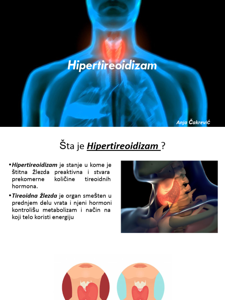 Hipertireoidizam | PDF