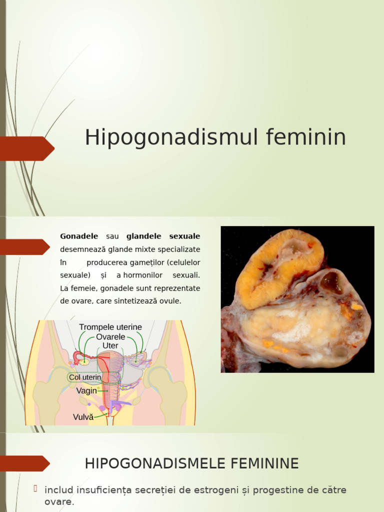 Hipogonadism Feminin | PDF