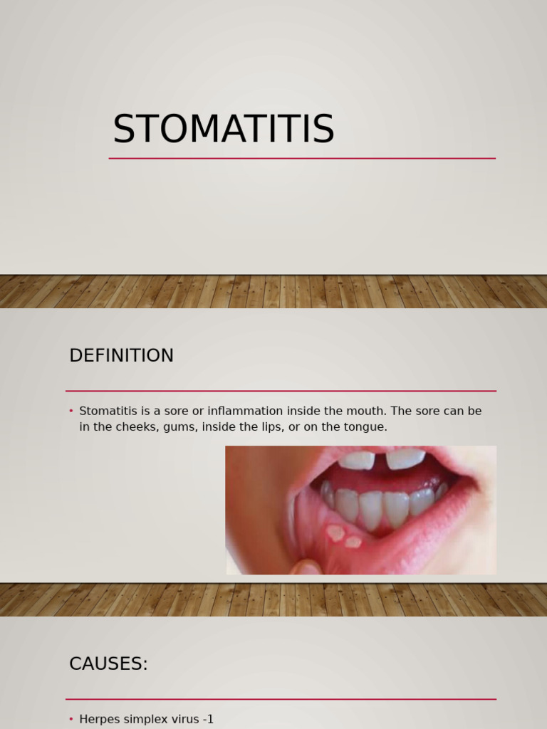 Stomatitis | PDF