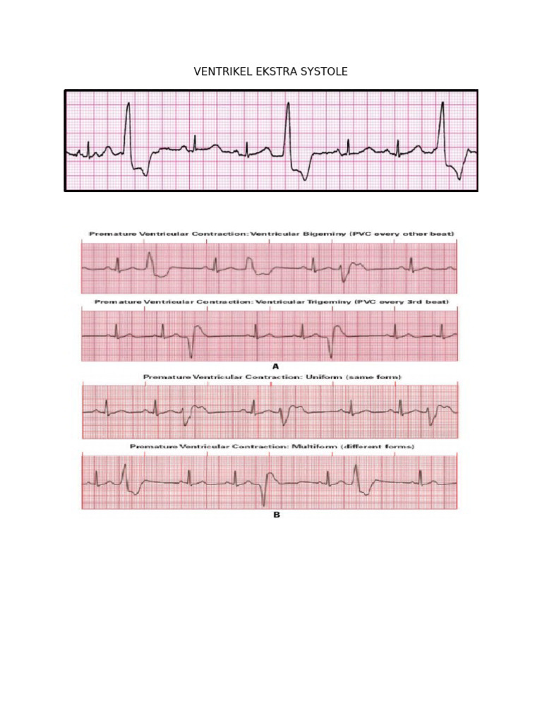 Ekg Abnormal | PDF