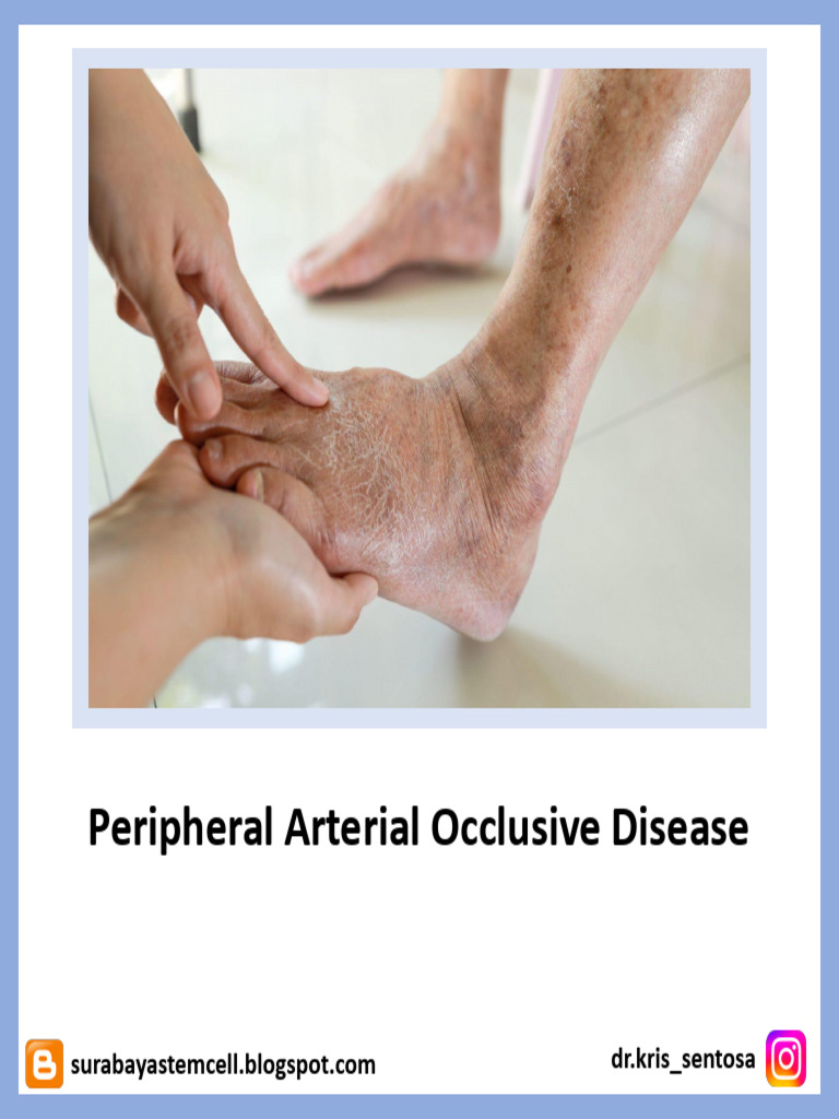 Peripheral Arterial Occlusive Disease | PDF