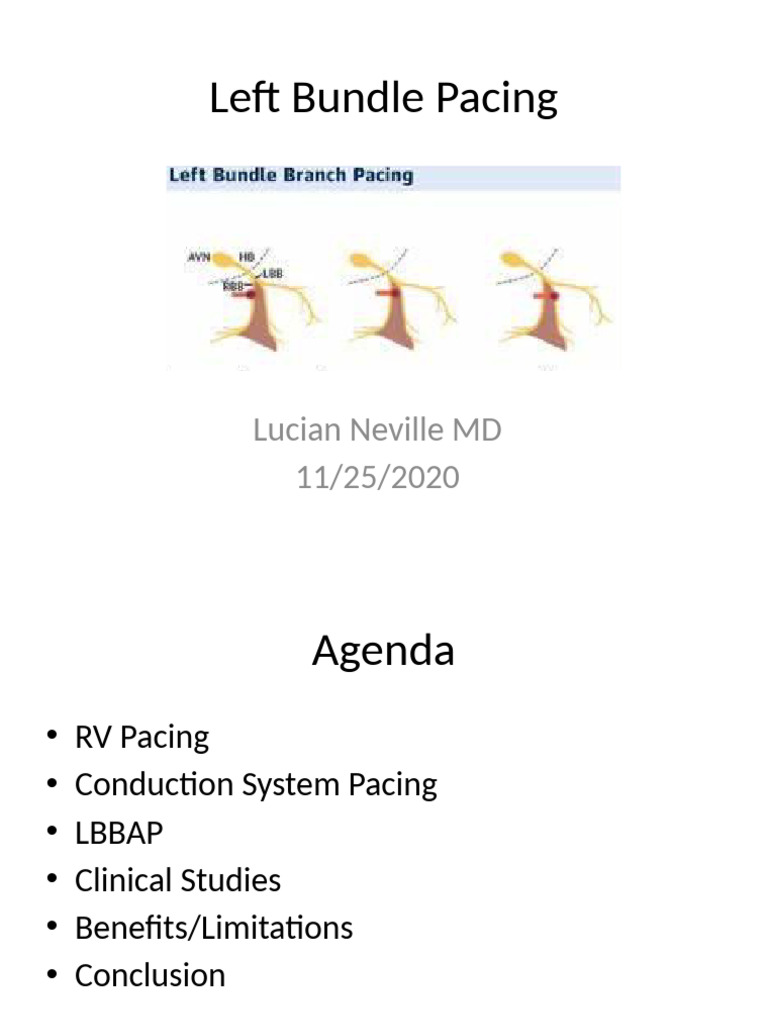 Left Bundle Pacing | PDF