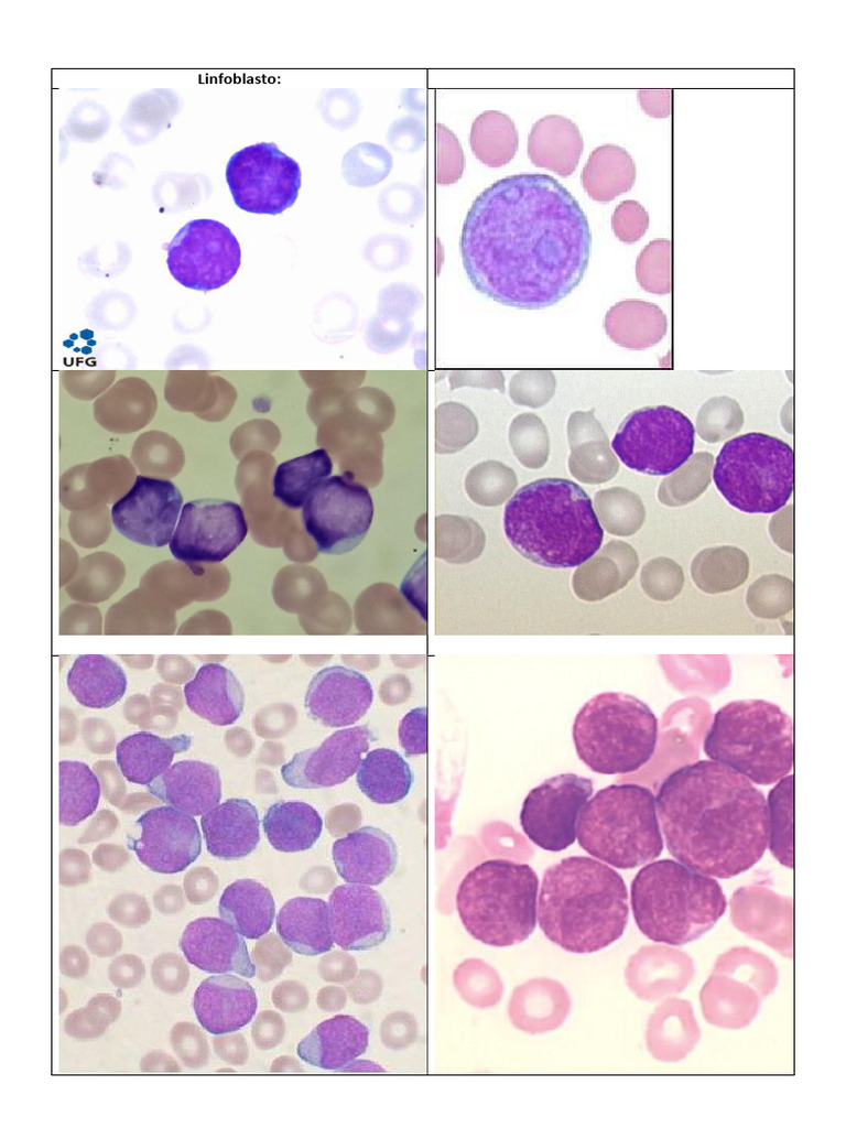 UT4 Imagenes Patologia-Linfoblasto | PDF