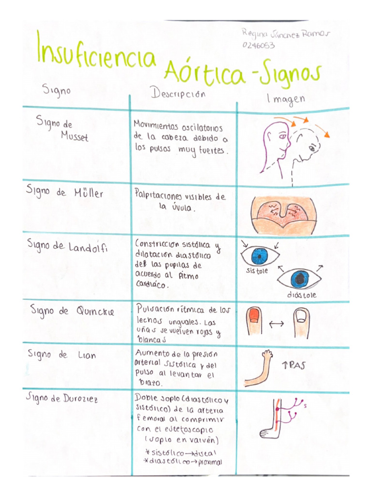 Signos de Insuficiencia Aórtica-Regina Sánchez Ramos | PDF