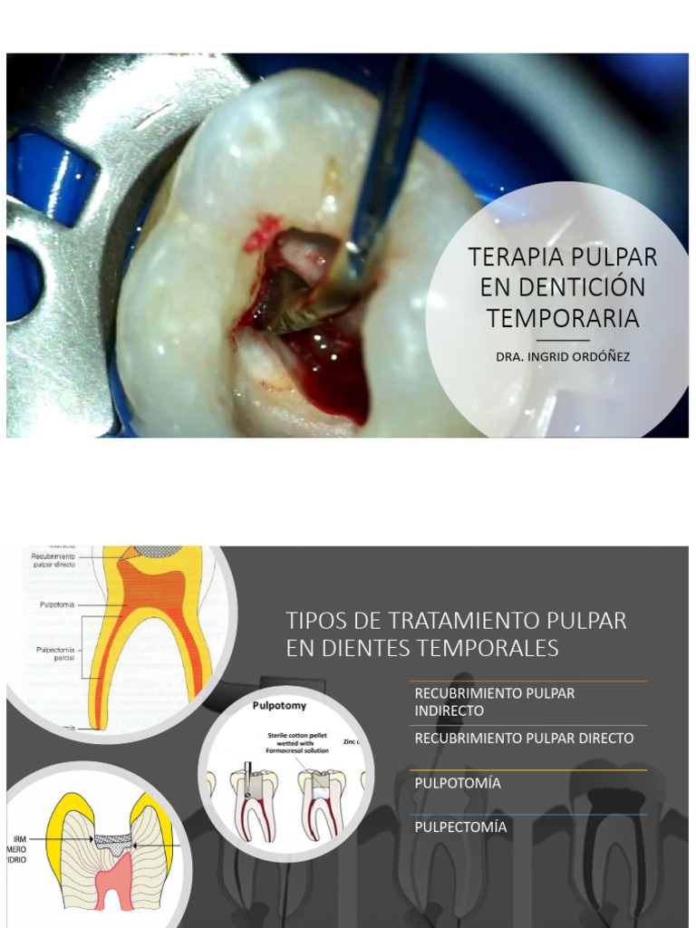 Terapia Pulpar en Temporarios | PDF
