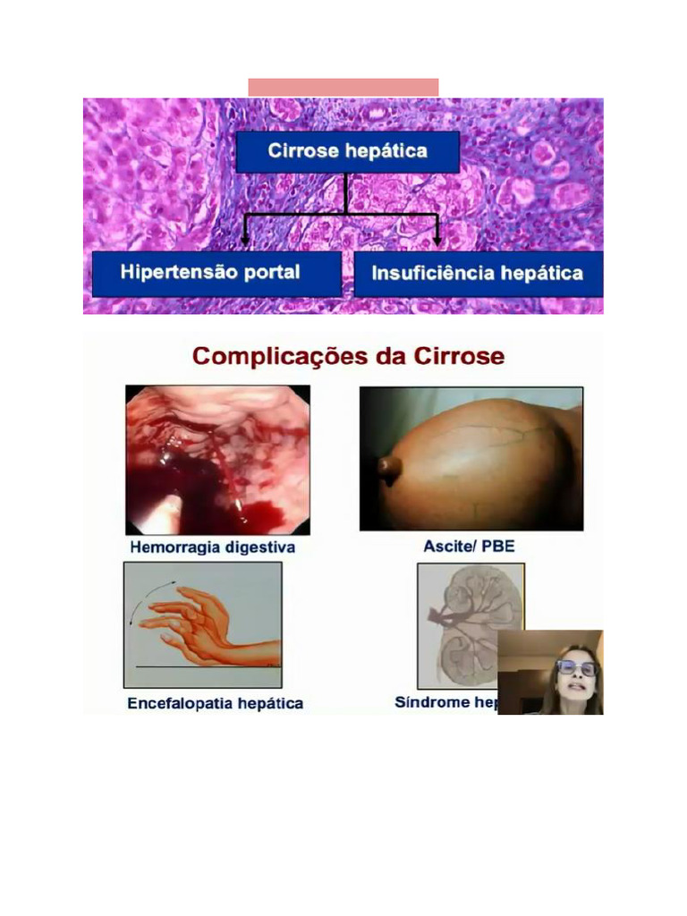 Complicações Da Cirrose | PDF