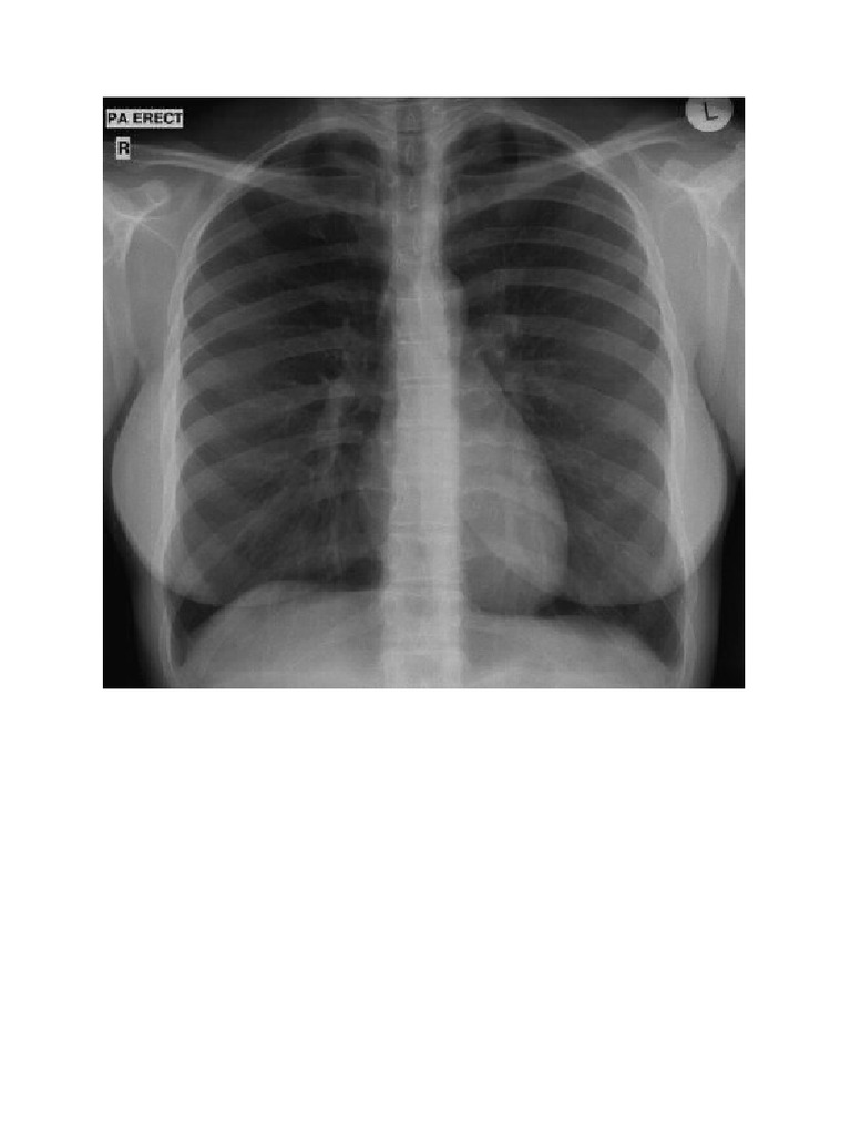 Chest Xrays | PDF