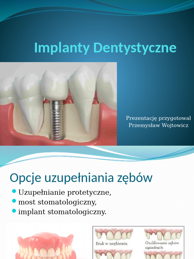 Implanty Dentystyczne | PDF