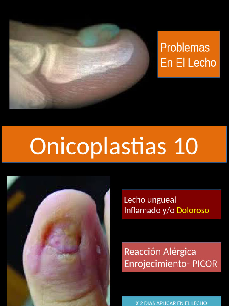 Onicoplastia 12 | PDF