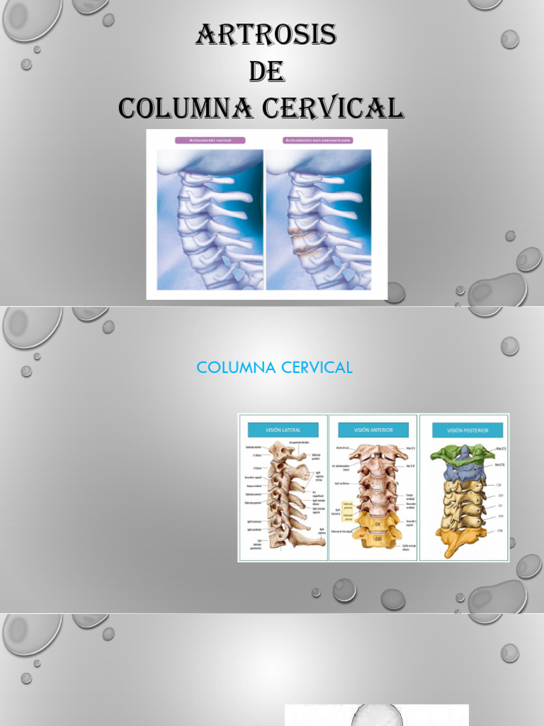 Artrosis Cervical Oficial | PDF