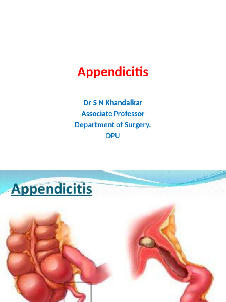Appendicitis | PDF