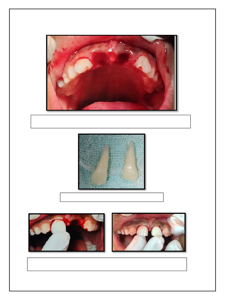 Avulsion | PDF