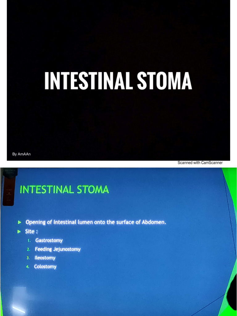 Intestinal Stoma - Surgery (Debabrata Sir) | PDF