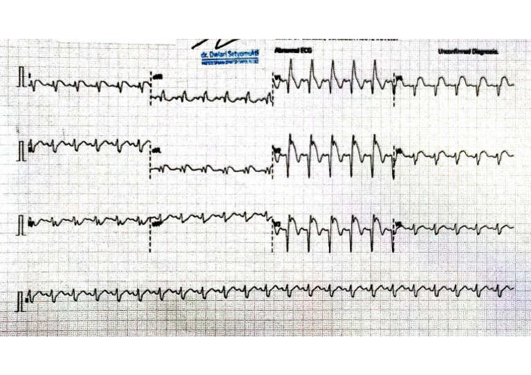 Ekg 2 | PDF