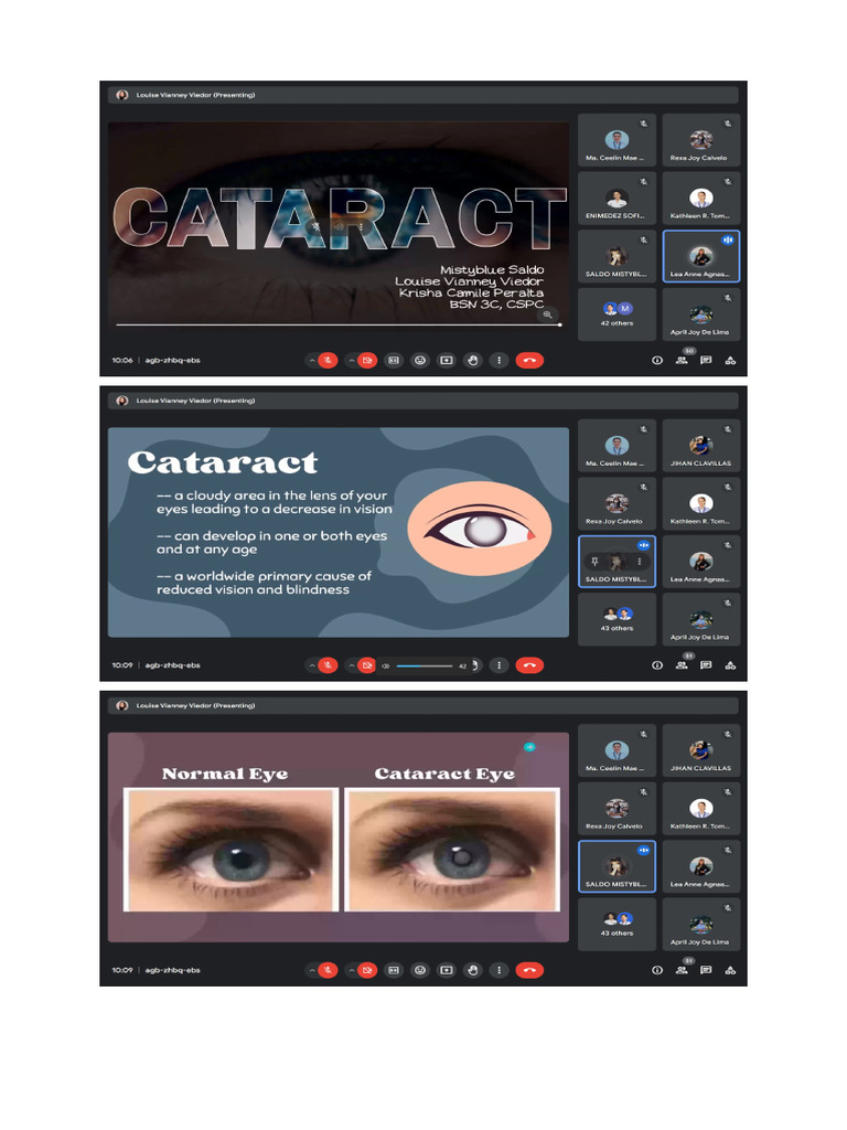 CATARACT | PDF
