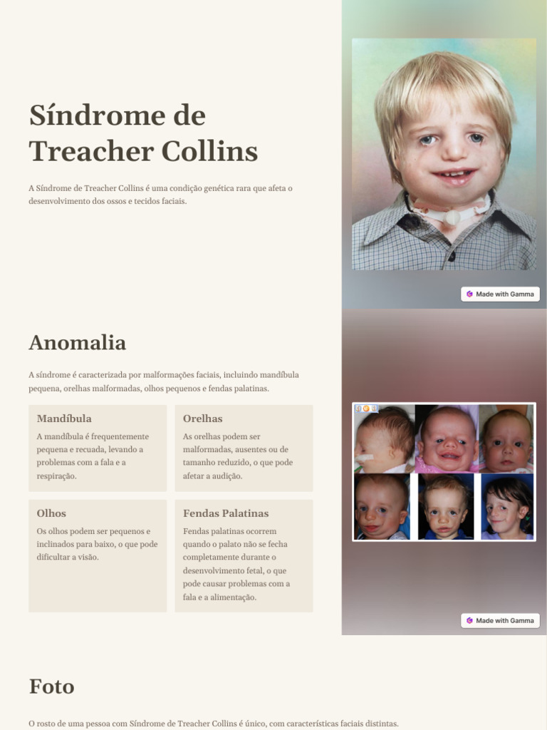 Sindrome de Treacher Collins | PDF