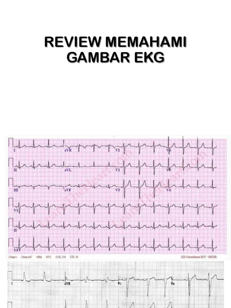 Review Memahami Gambar Ekg | PDF