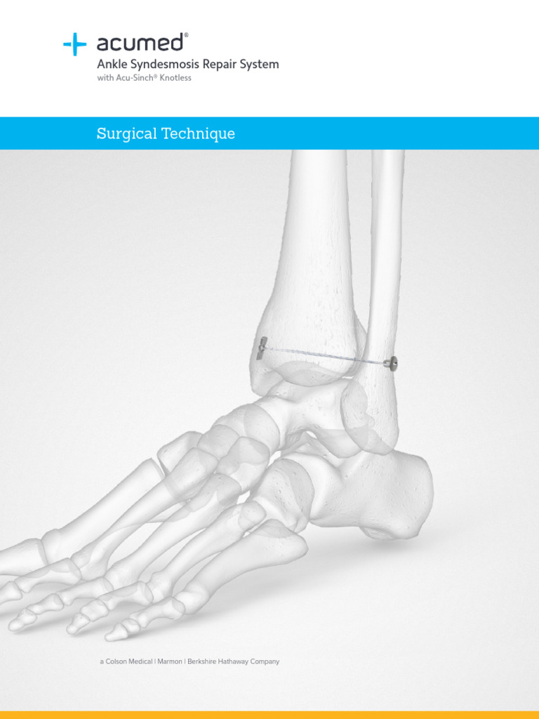 Acumed Surgical Technique EN Ankle Syndesmosis Repair System TLB00 01 E ...
