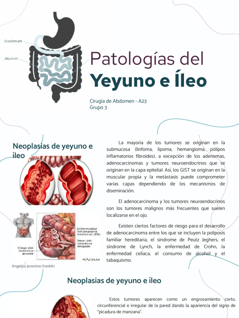 Tumores y Fístulas en Yeyuno e Íleo | PDF | Tracto gastrointestinal ...