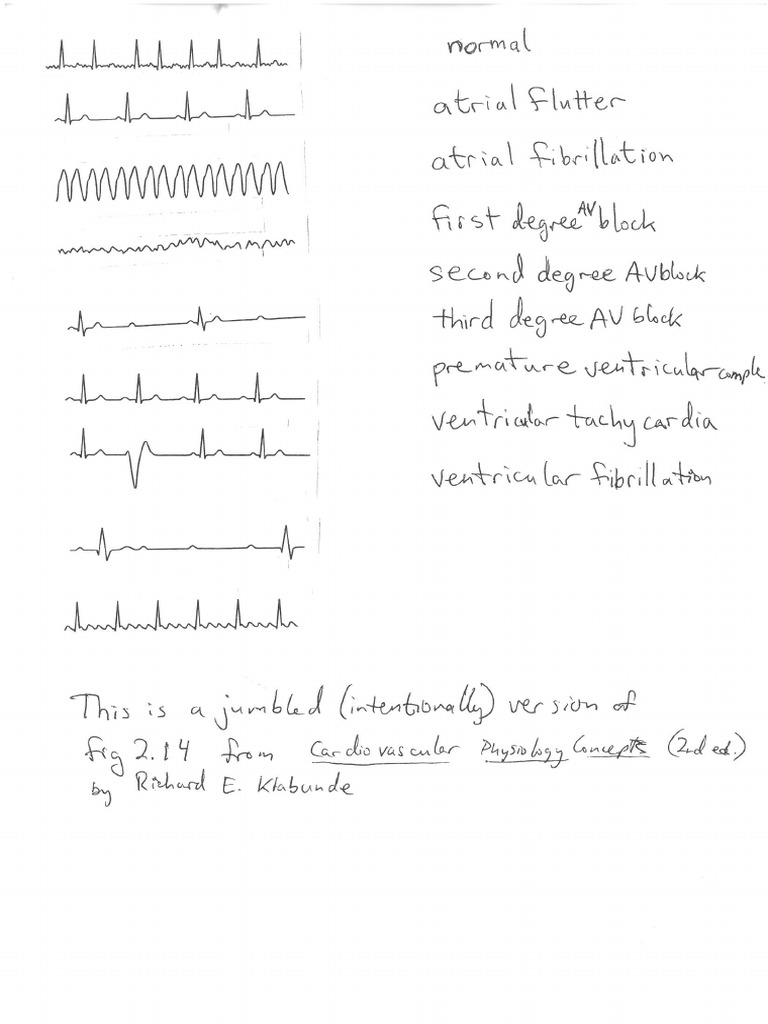 aberrant ECG | PDF