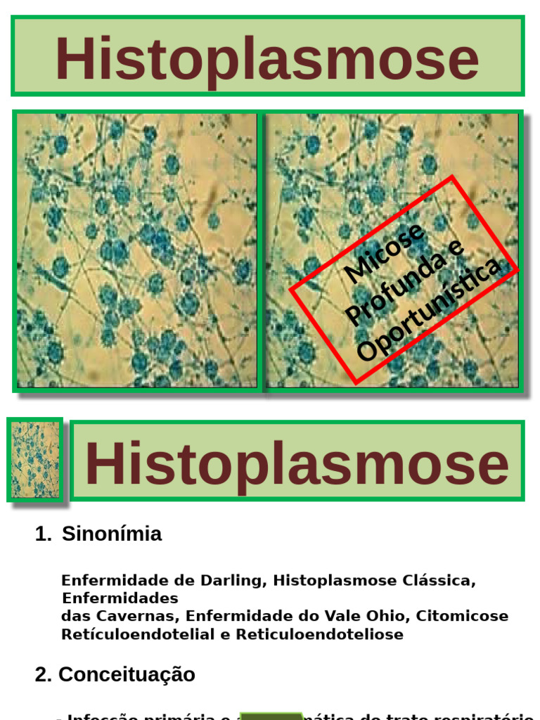 Histoplasmose (Aula Clínica 08) UFG Laboratório de Fungos Pa | PDF