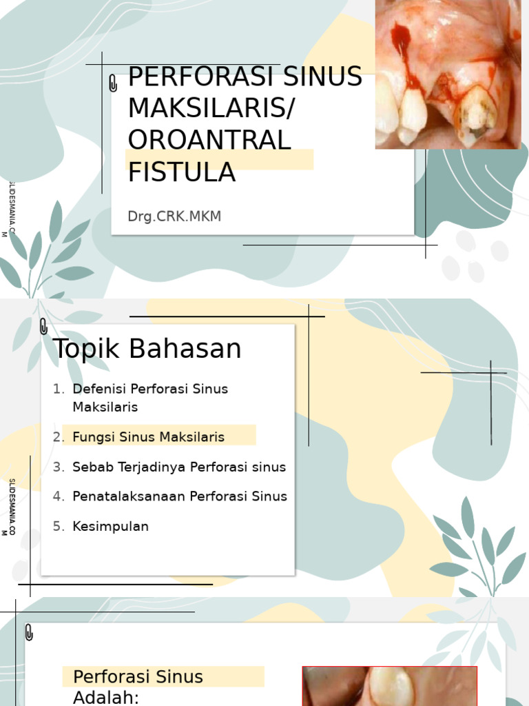 TM II Perforasi Sinus | PDF