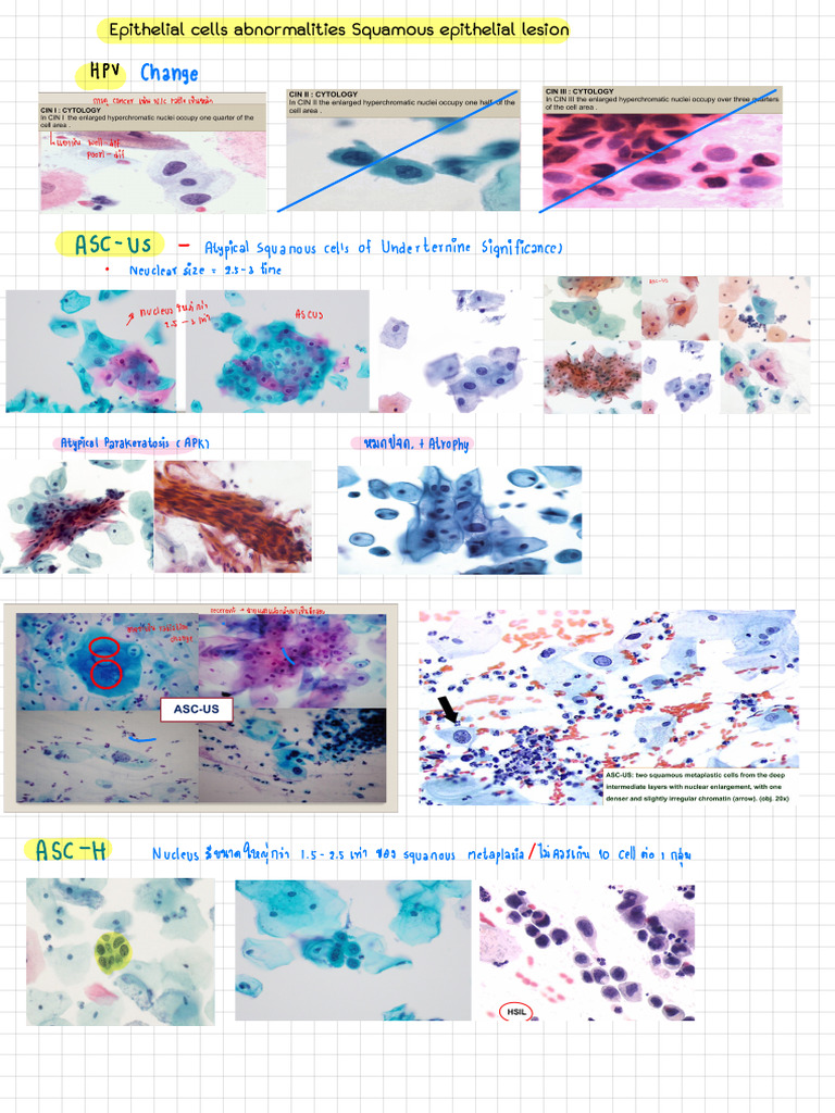 สรุป Lab Gyne 5 Epithelial cells abnormalities Squamous epithelial ...