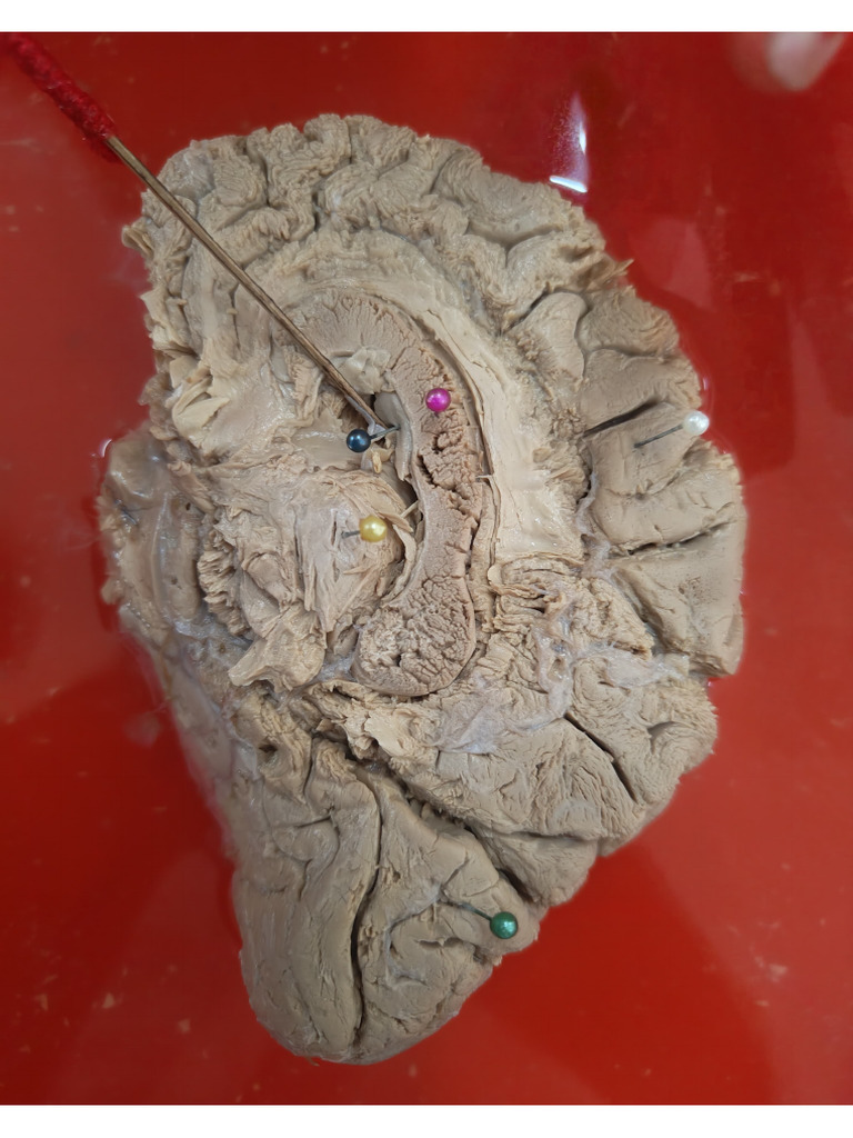 Gross - Medial Section of Brain | PDF