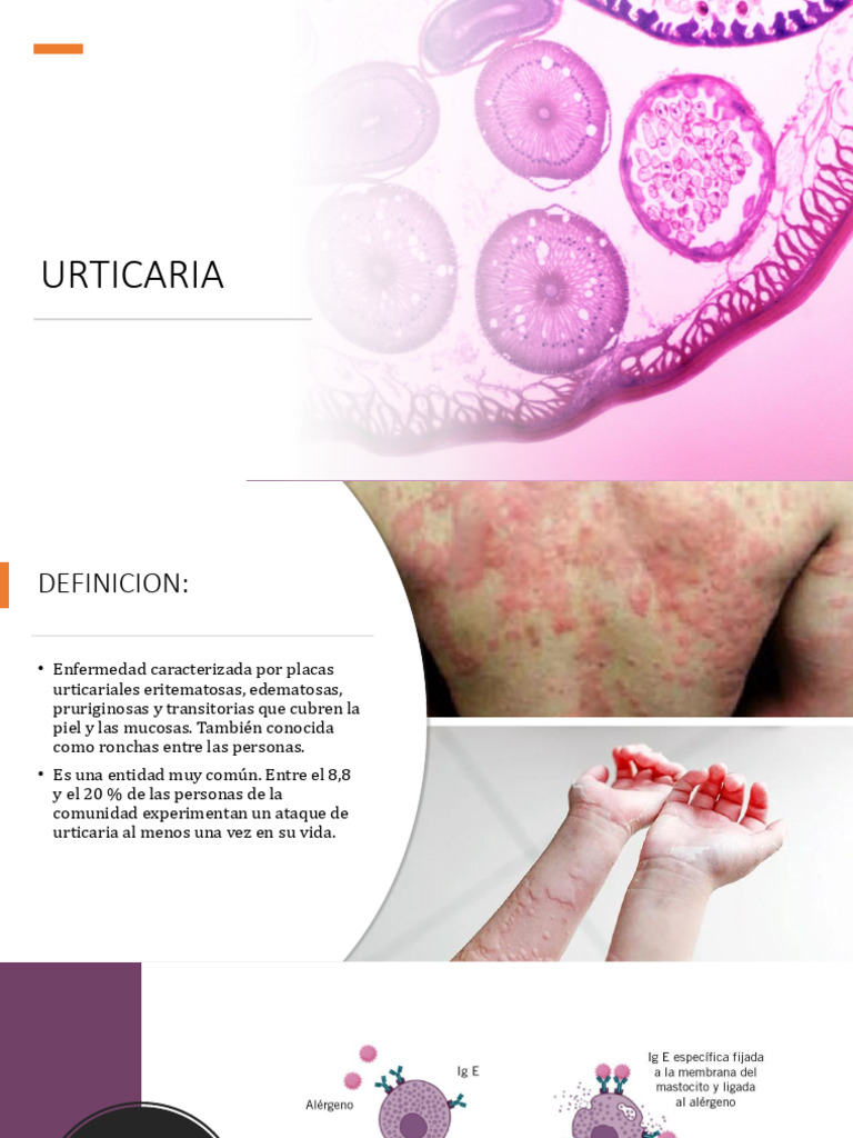Fisiopatología de La Urticaria | PDF