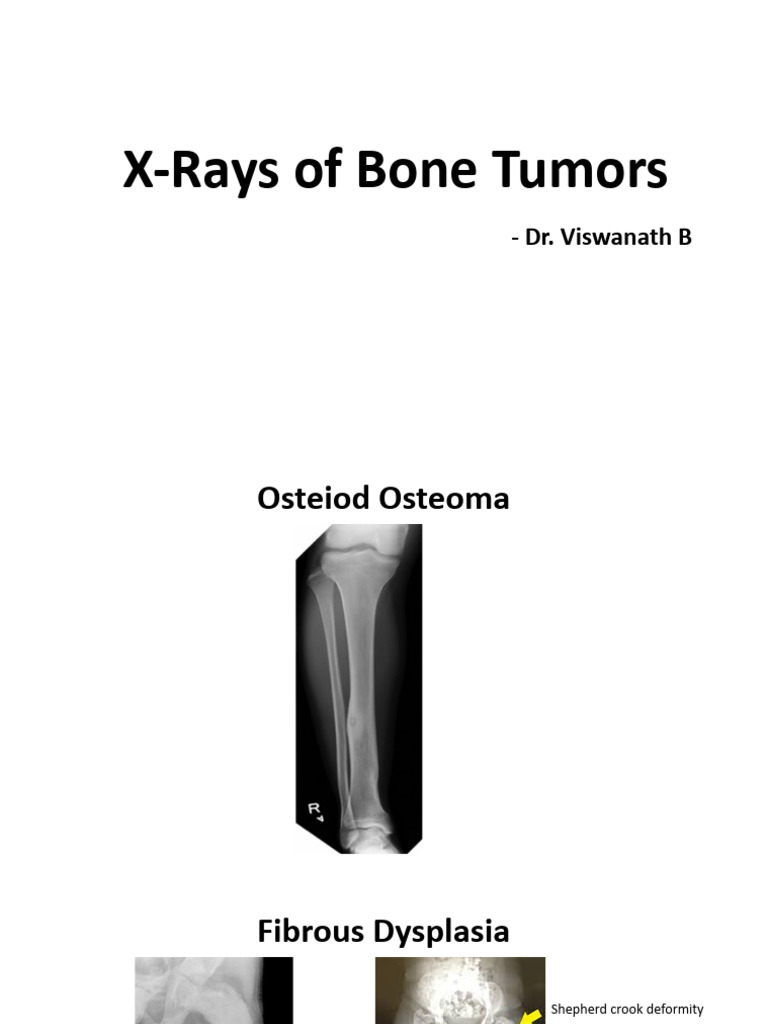 X-Rays of Bone Tumors - PPTX - Dr. Viswanath B | PDF