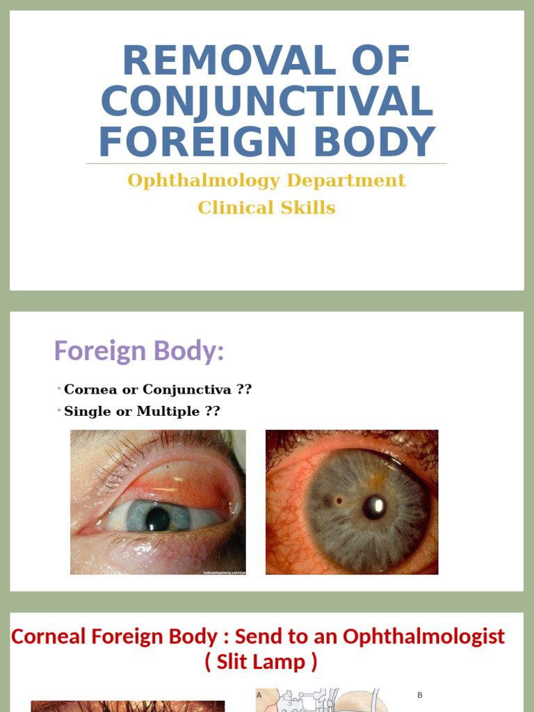 Conjunctival Foreign Body Removal | PDF