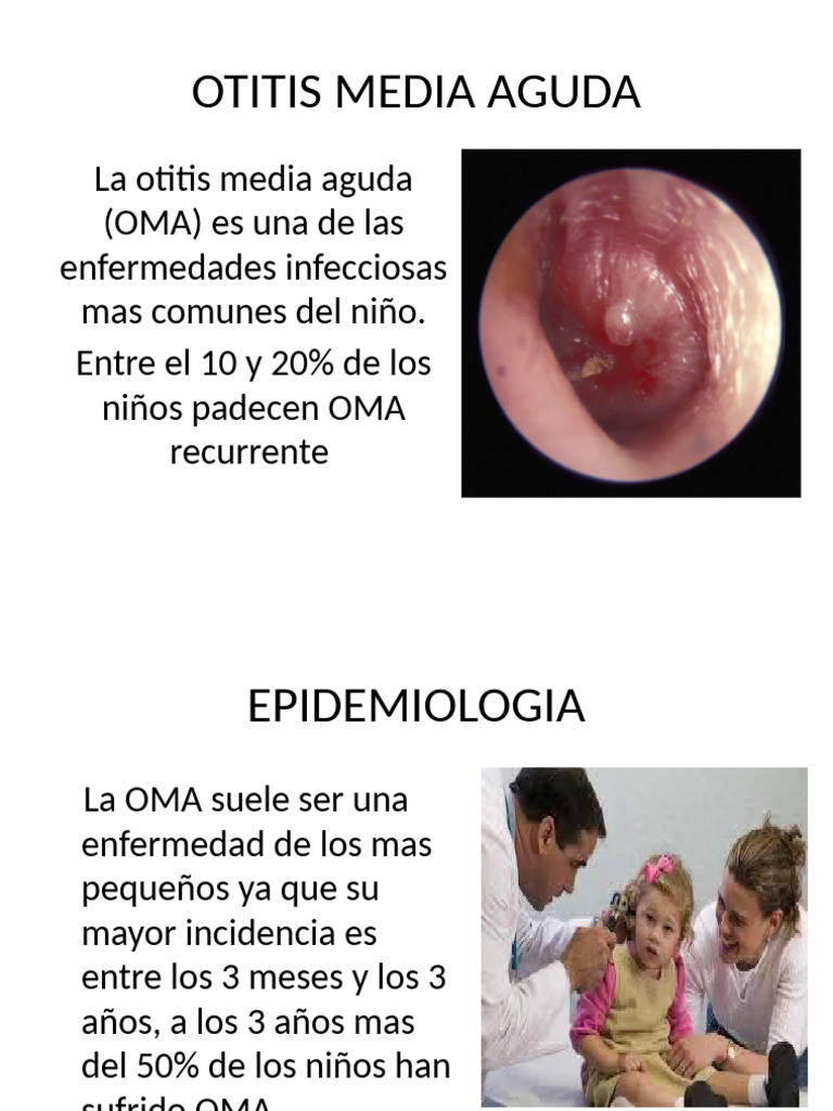 Otitis Media Aguda 22222 | PDF