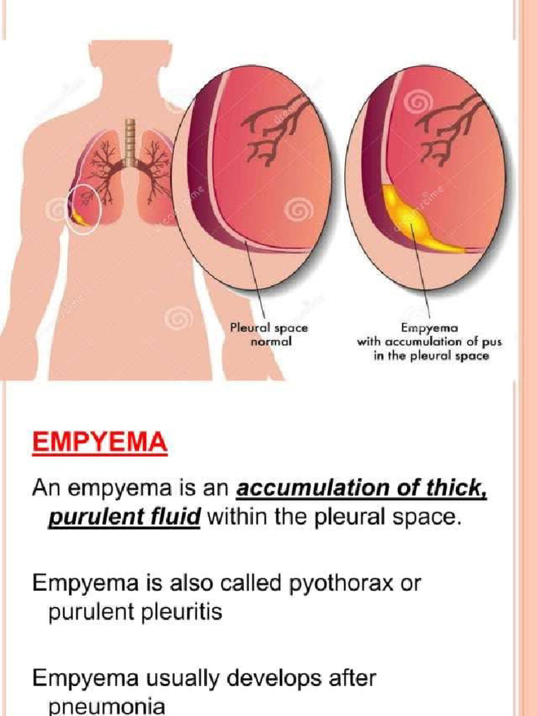 Empyema | PDF